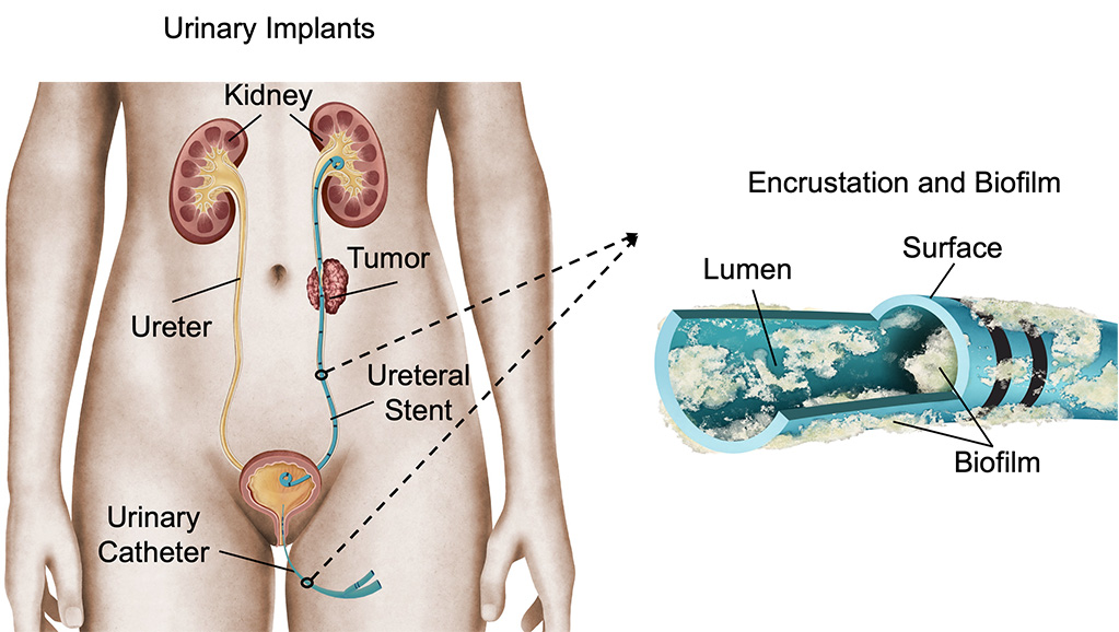 ureteral stent diagram